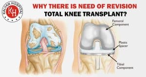 Frequently Asked Questions (FAQS) - Revision Total Knee Transplant